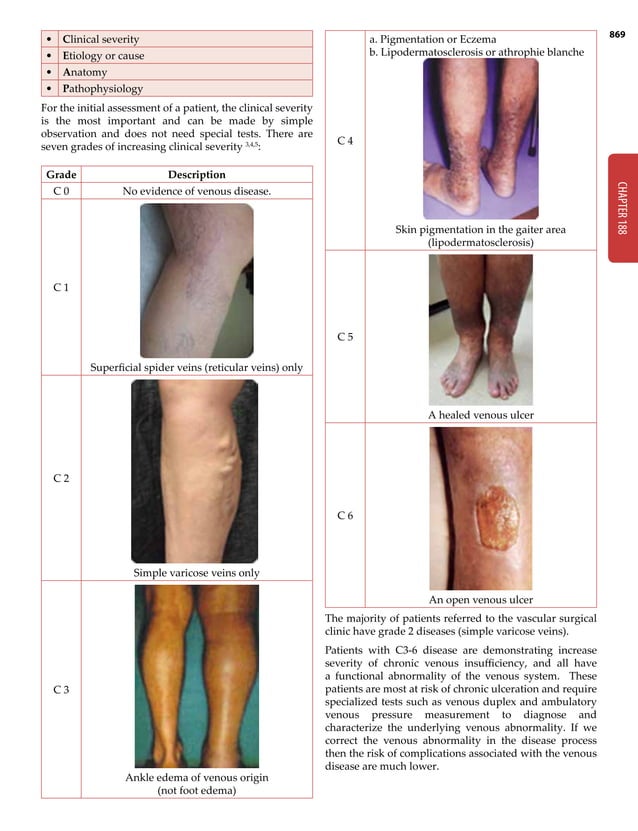 Anatomy, Physiology & Classification of Varicose Veins | PDF
