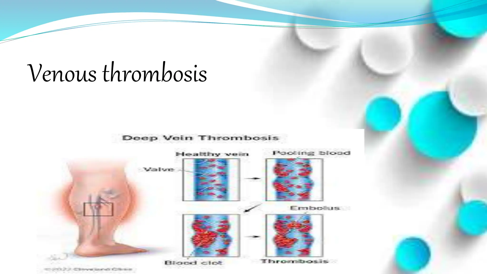 VARICOSE VEINS & DEEP VENOUS THROMBOSIS.pptx