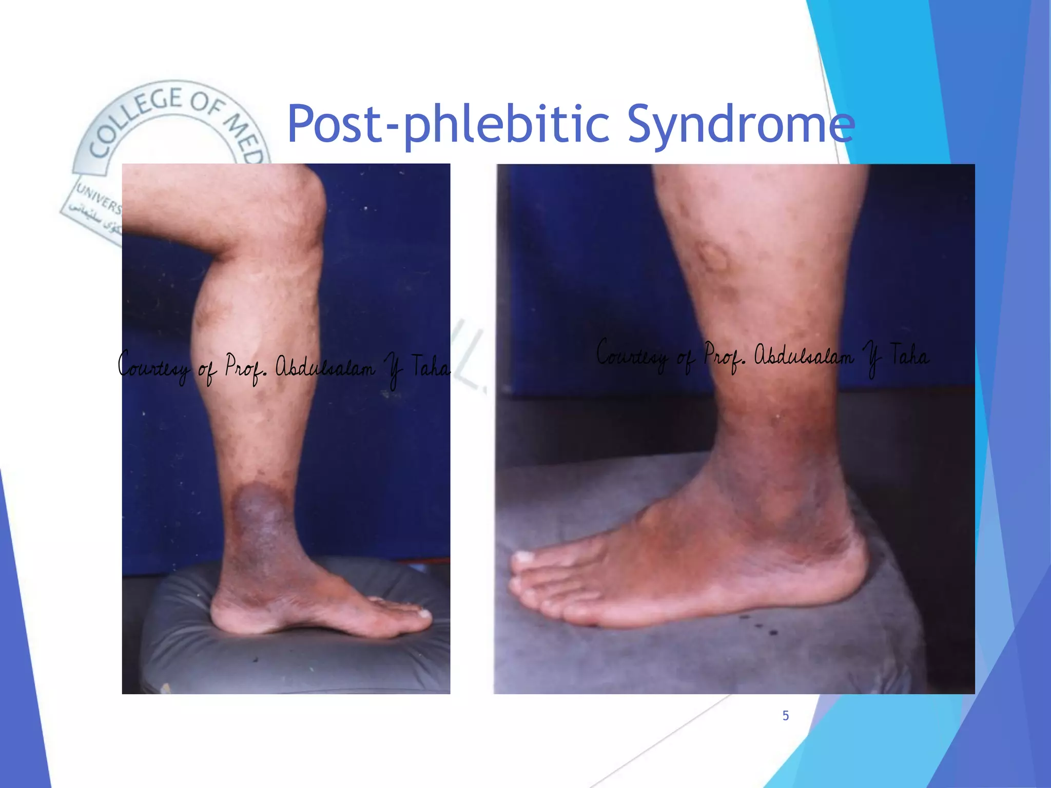 Varicose Veins Pictures.pdf