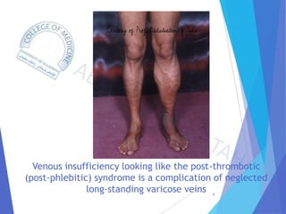 Varicose Veins Pictures.pdf