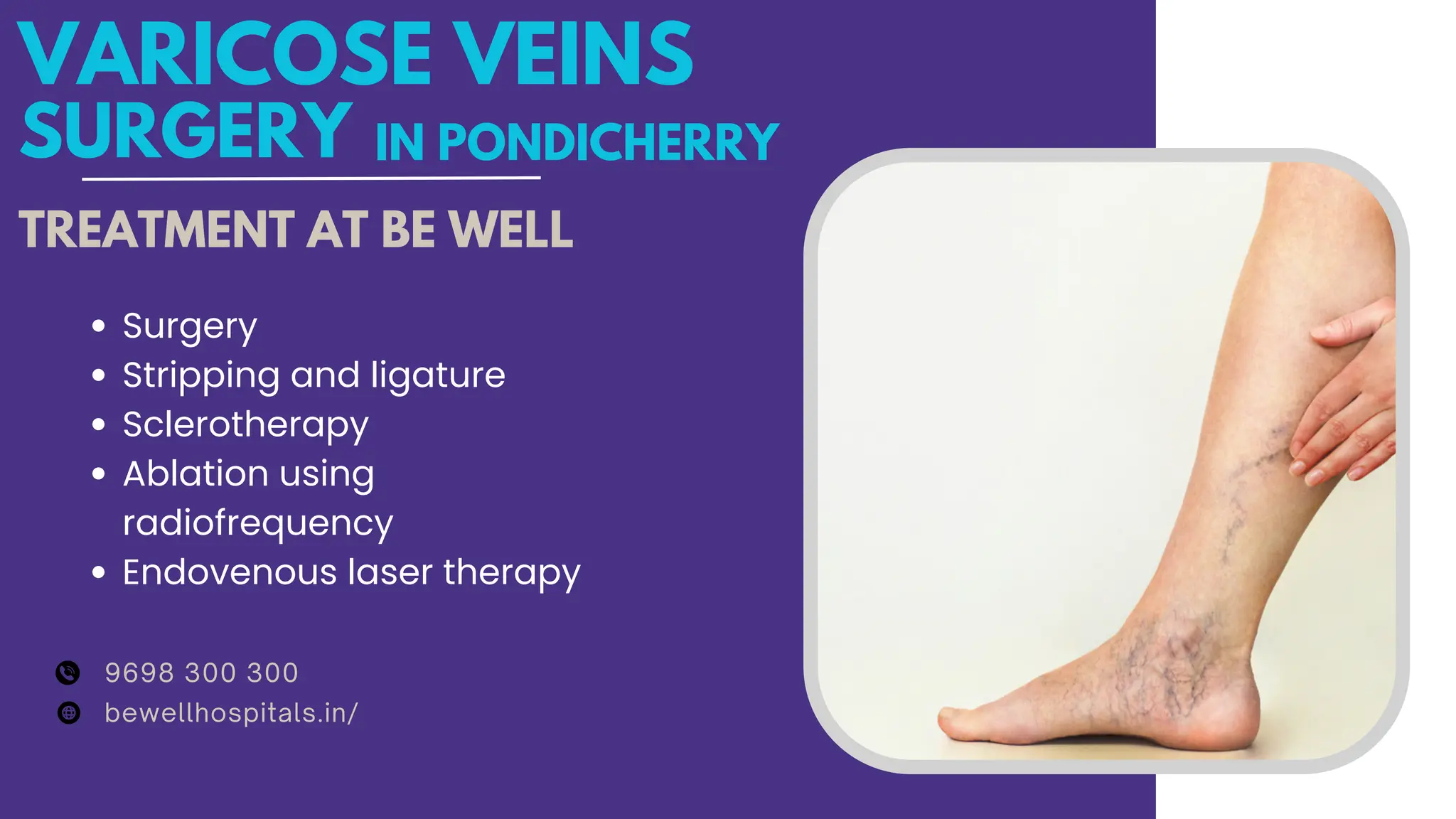 Varicose Veins Surgery in Pondicherry.pdf