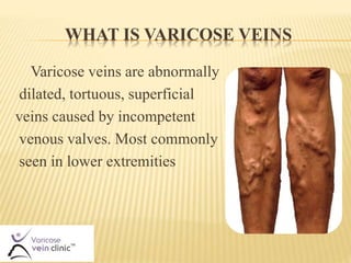 Varicose Veins Treatment in Hyderabad | Veindoctor Clinic | PPT