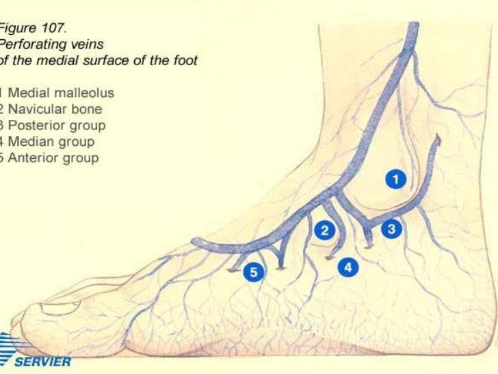 Varicose veins
