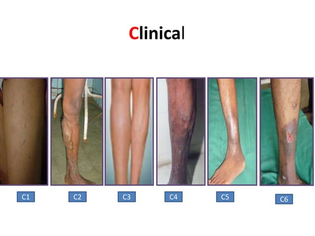 Varicose vein, Venous ulcer.pptx | First Aid | Injuries