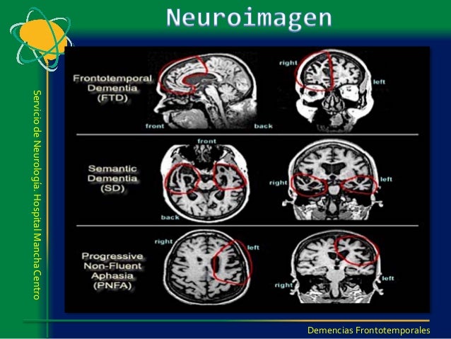Variantes temporales de la degeneración lobular frontotemporal