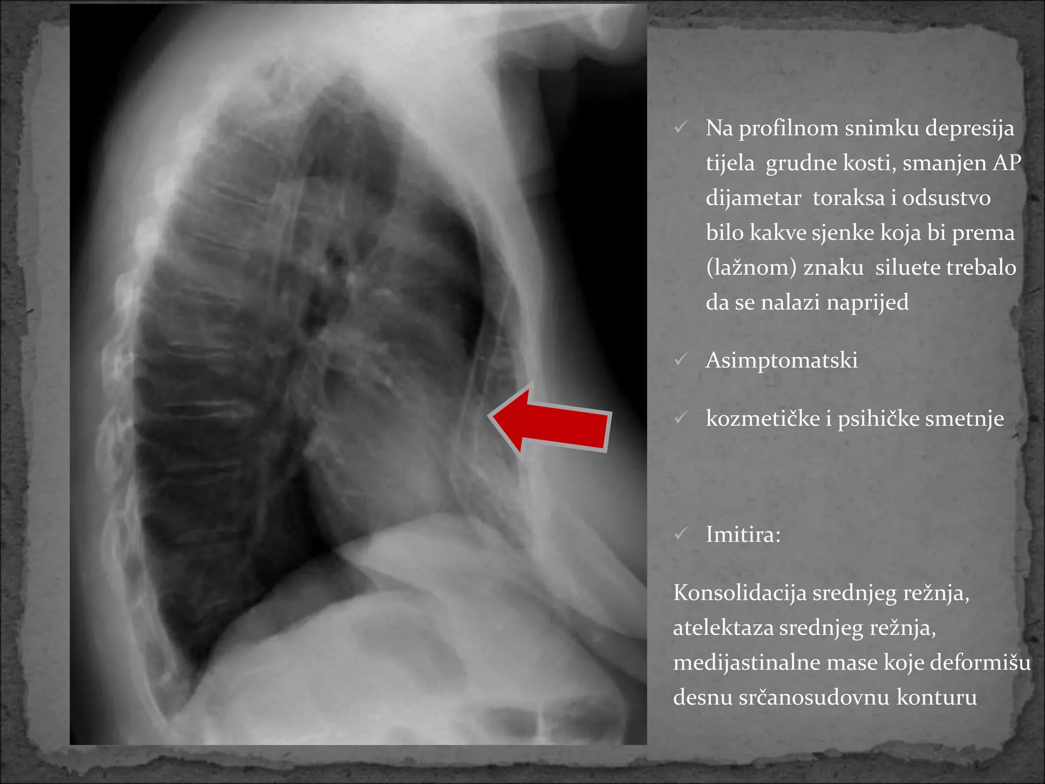 Varijeteti i lazno patoloski nalazi na RTG snimku pluca | PPTX