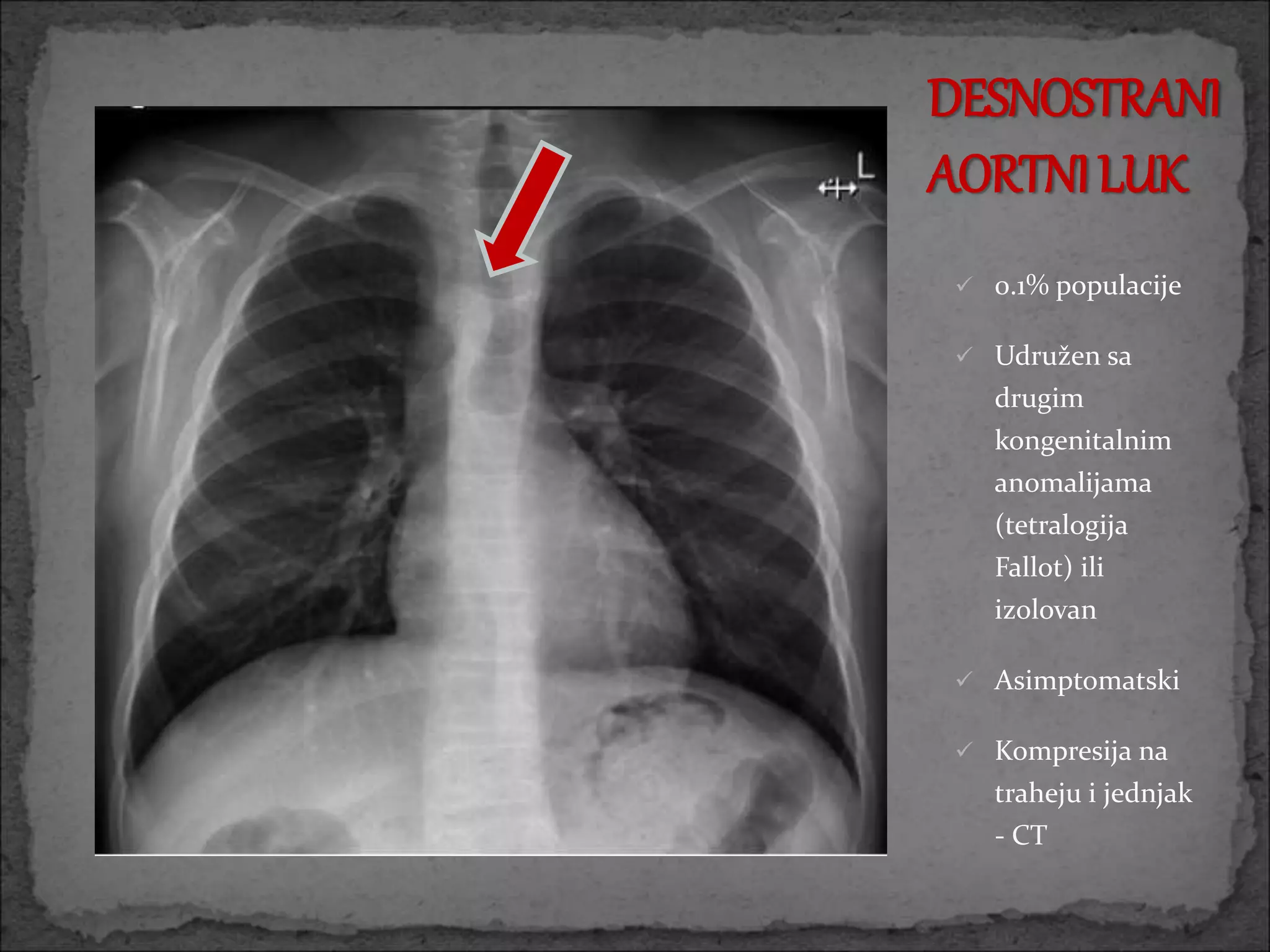 Varijeteti i lazno patoloski nalazi na RTG snimku pluca | PPTX