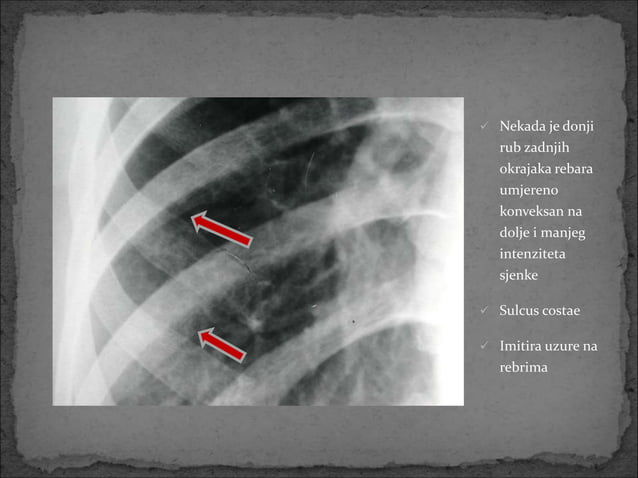 Varijeteti i lazno patoloski nalazi na RTG snimku pluca | PPTX