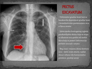 Varijeteti i lazno patoloski nalazi na RTG snimku pluca | PPTX