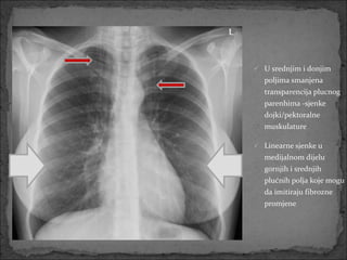 Varijeteti i lazno patoloski nalazi na RTG snimku pluca | PPTX