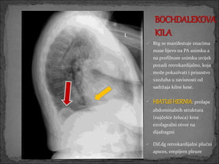 Varijeteti i lazno patoloski nalazi na RTG snimku pluca | PPTX