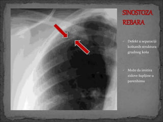 Varijeteti i lazno patoloski nalazi na RTG snimku pluca | PPTX