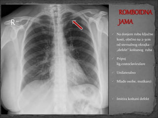 Varijeteti i lazno patoloski nalazi na RTG snimku pluca | PPTX