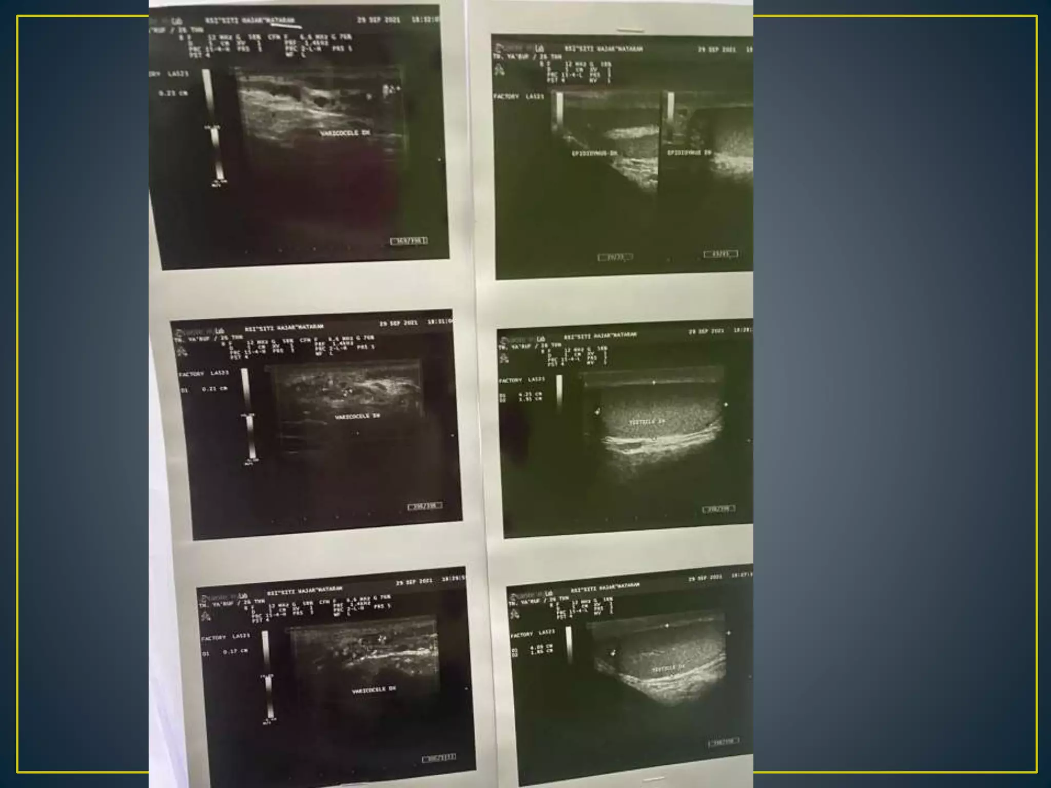 Varikokel bilateral | PPTX