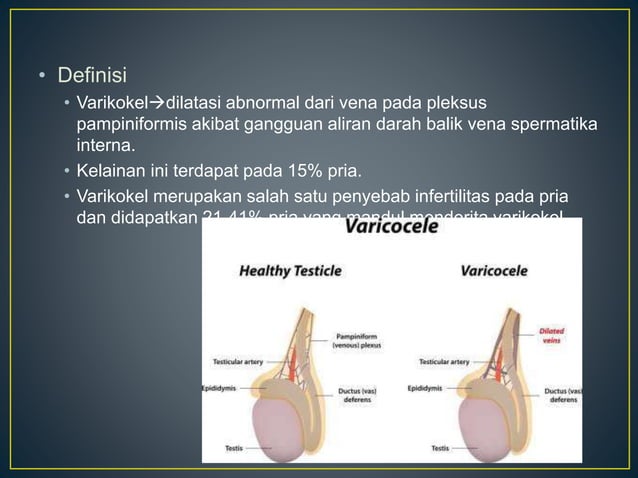 Varikokel bilateral | PPTX