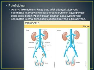Varikokel bilateral | PPTX