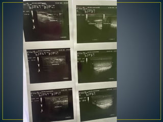 Varikokel bilateral | PPTX