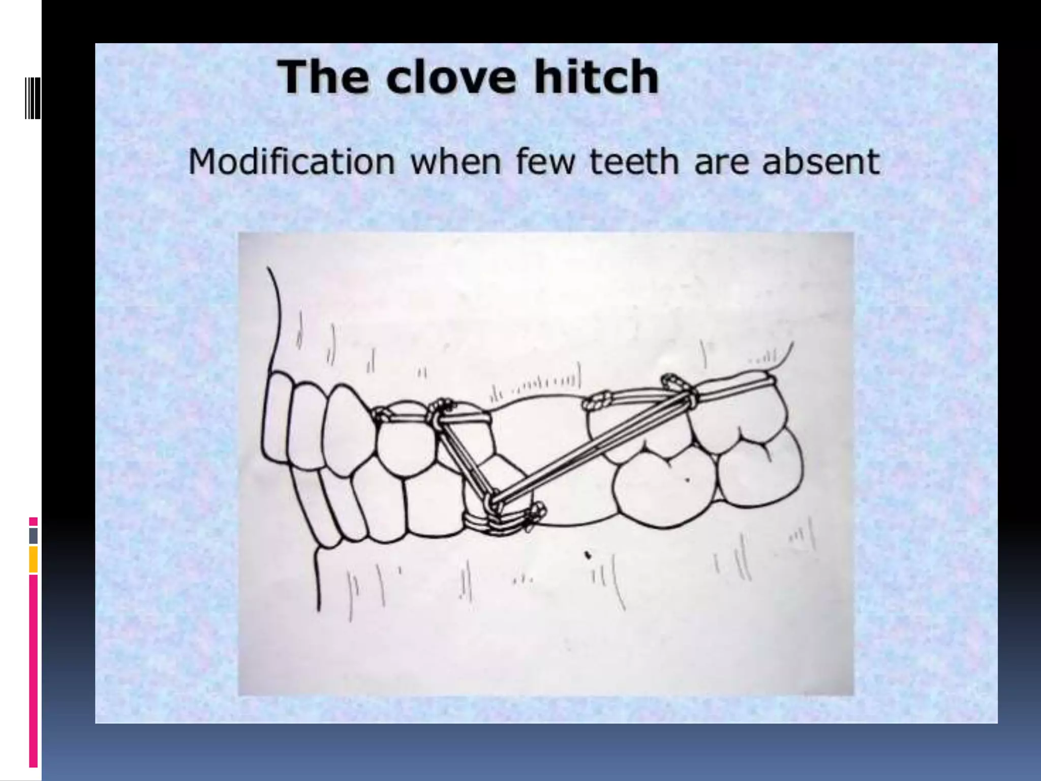 Various intermaxillary fixation techniques | PPTX