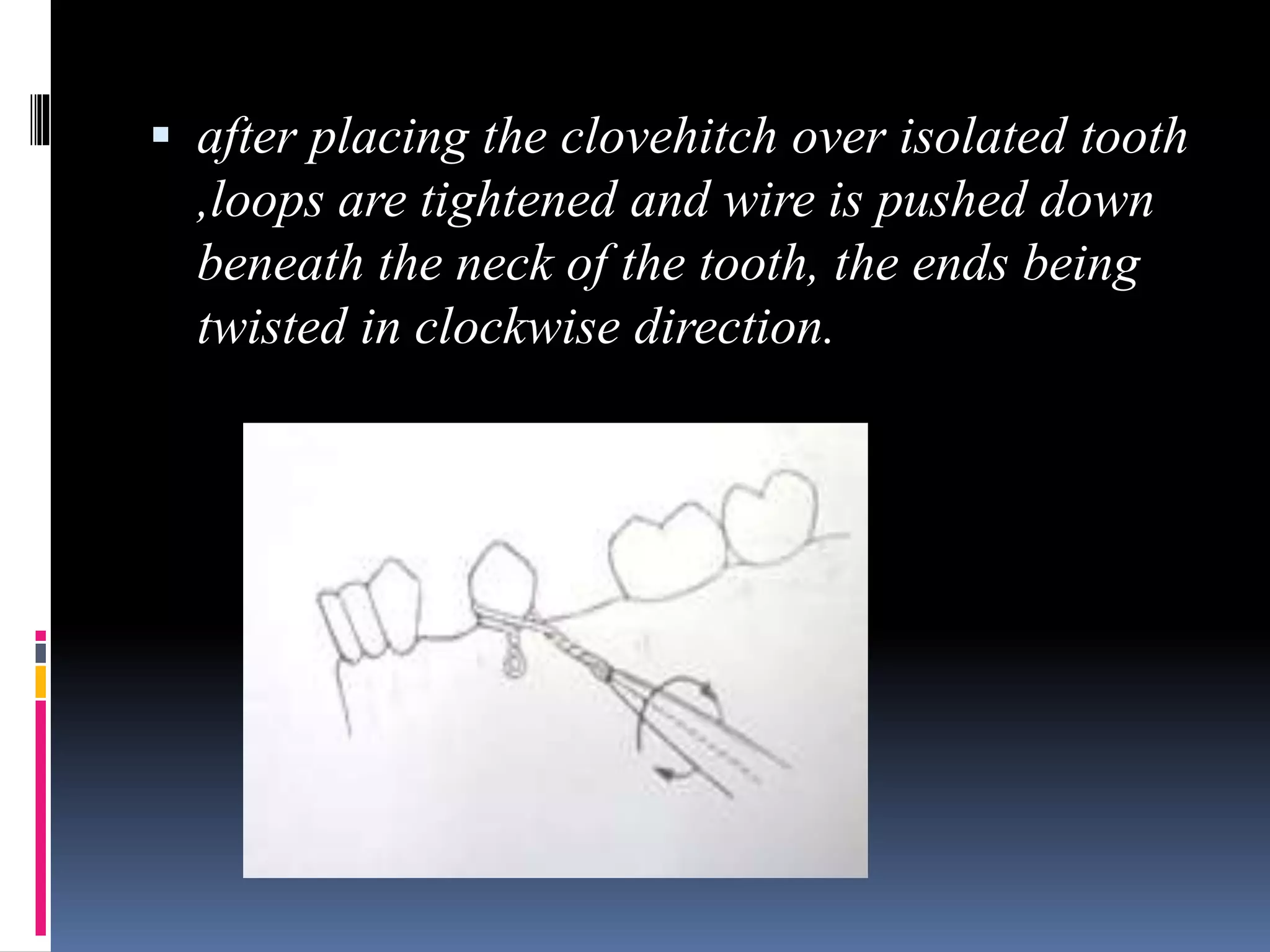 Various intermaxillary fixation techniques | PPTX