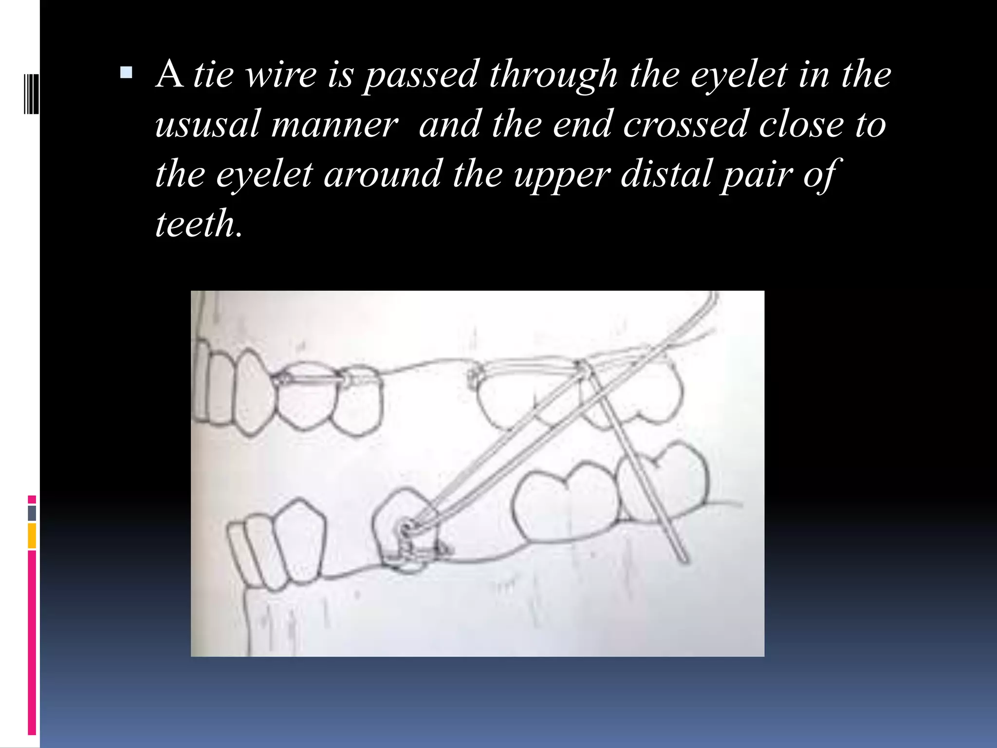 Various intermaxillary fixation techniques | PPTX