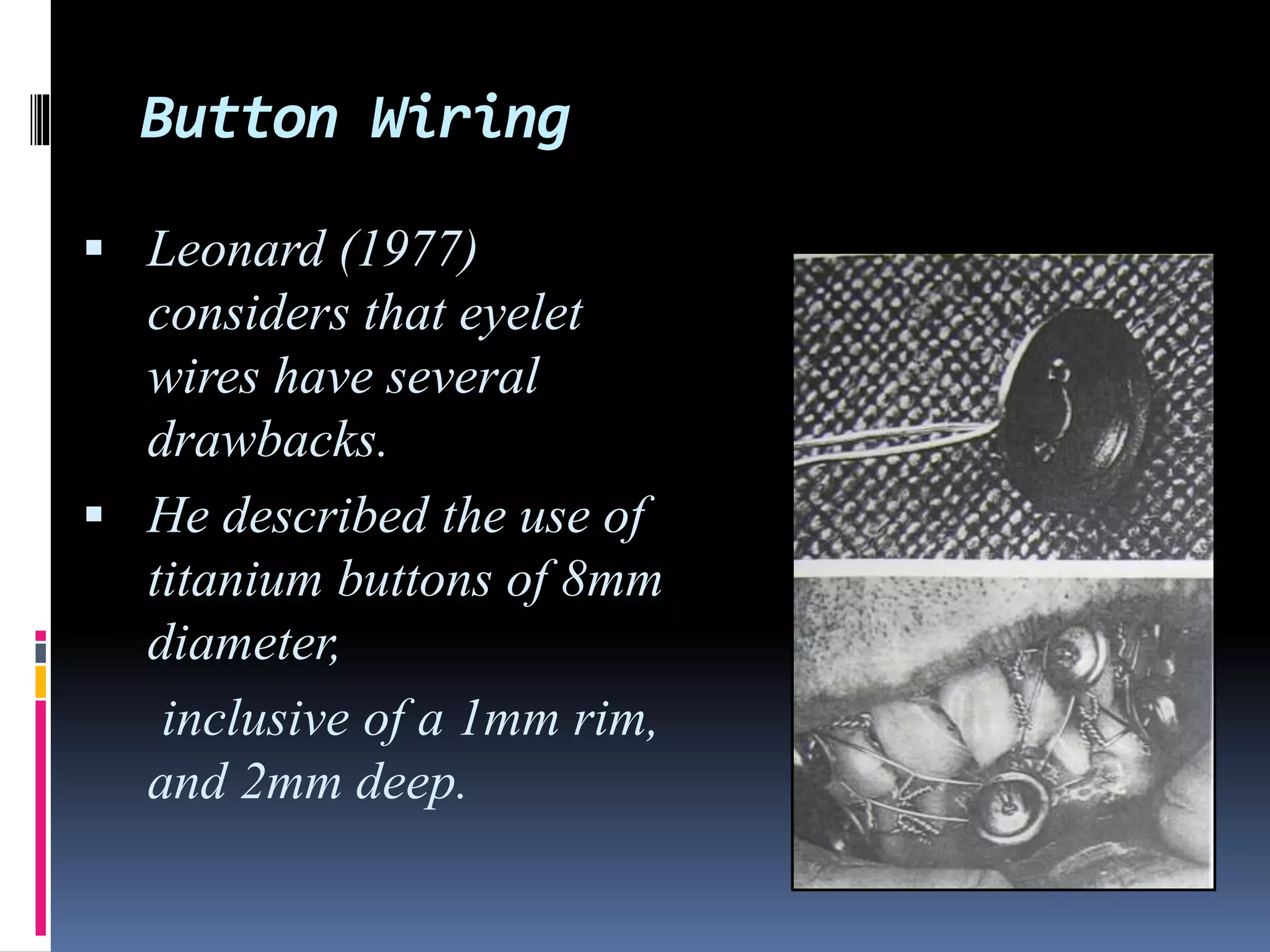 Various intermaxillary fixation techniques | PPTX
