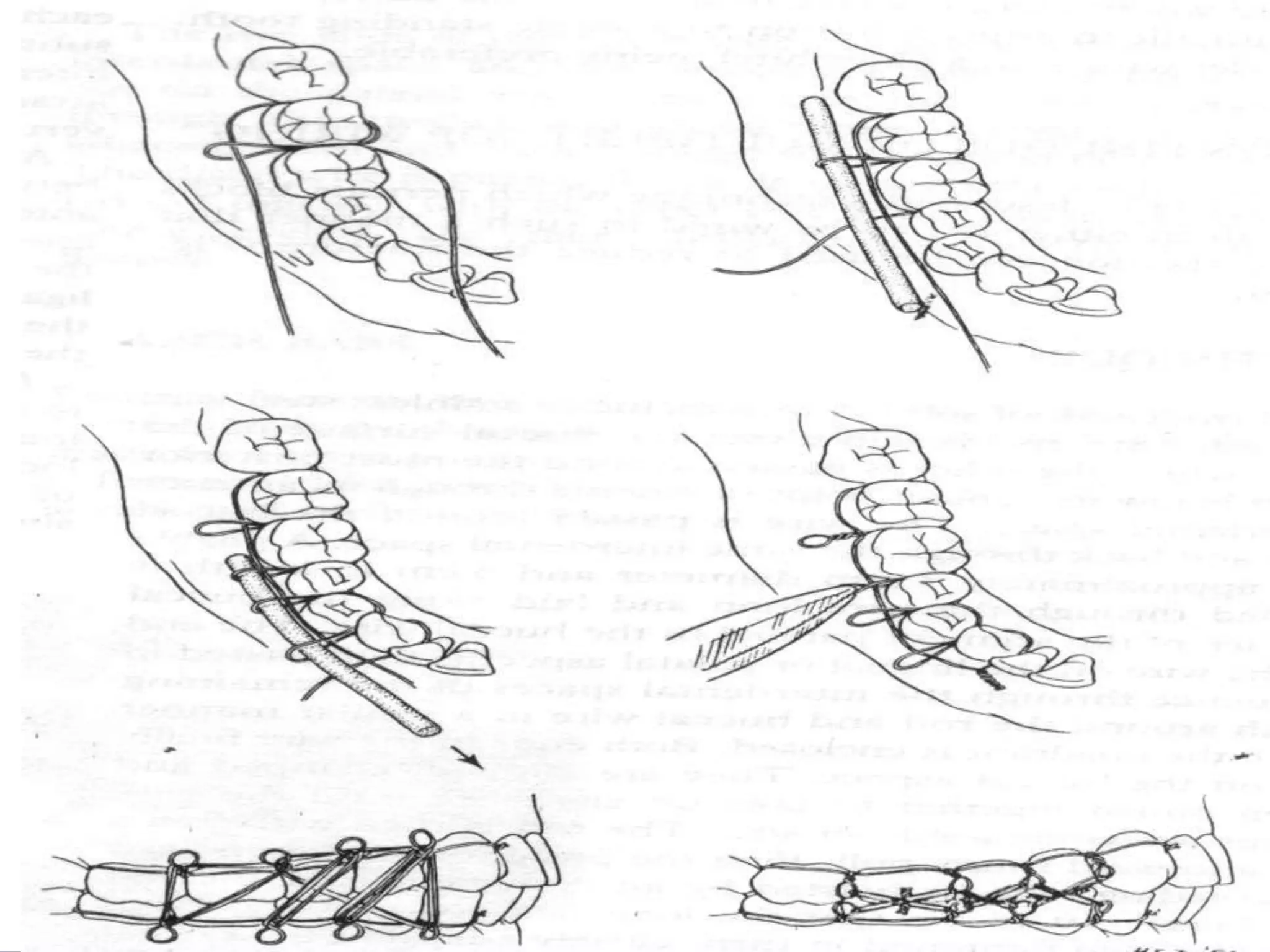 Various intermaxillary fixation techniques | PPTX