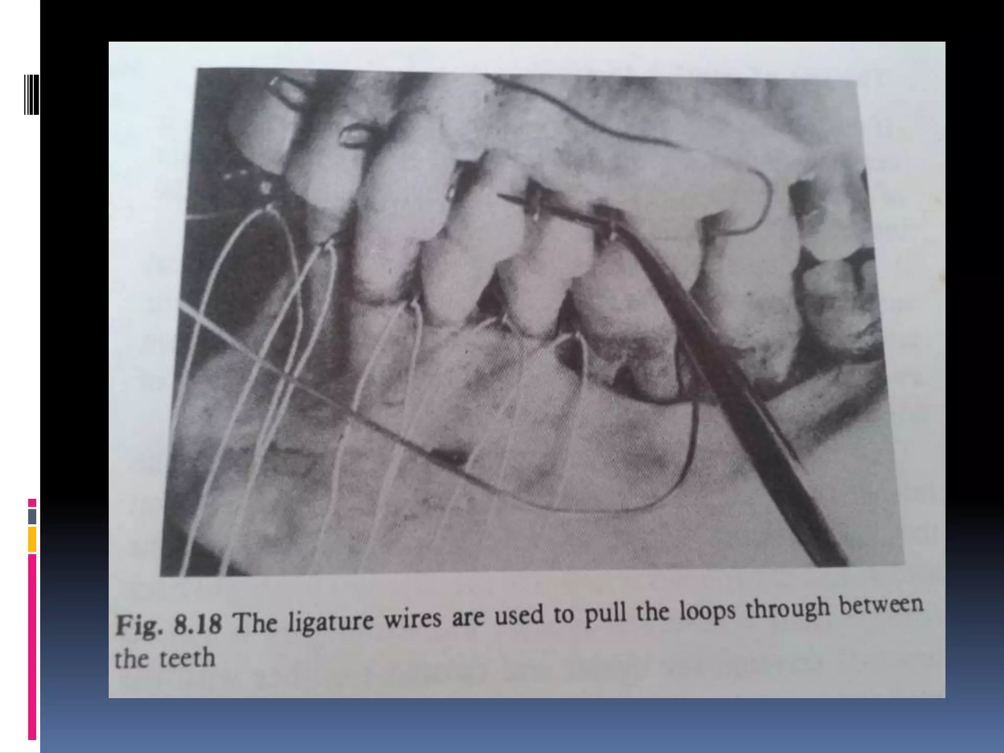 Various intermaxillary fixation techniques | PPTX