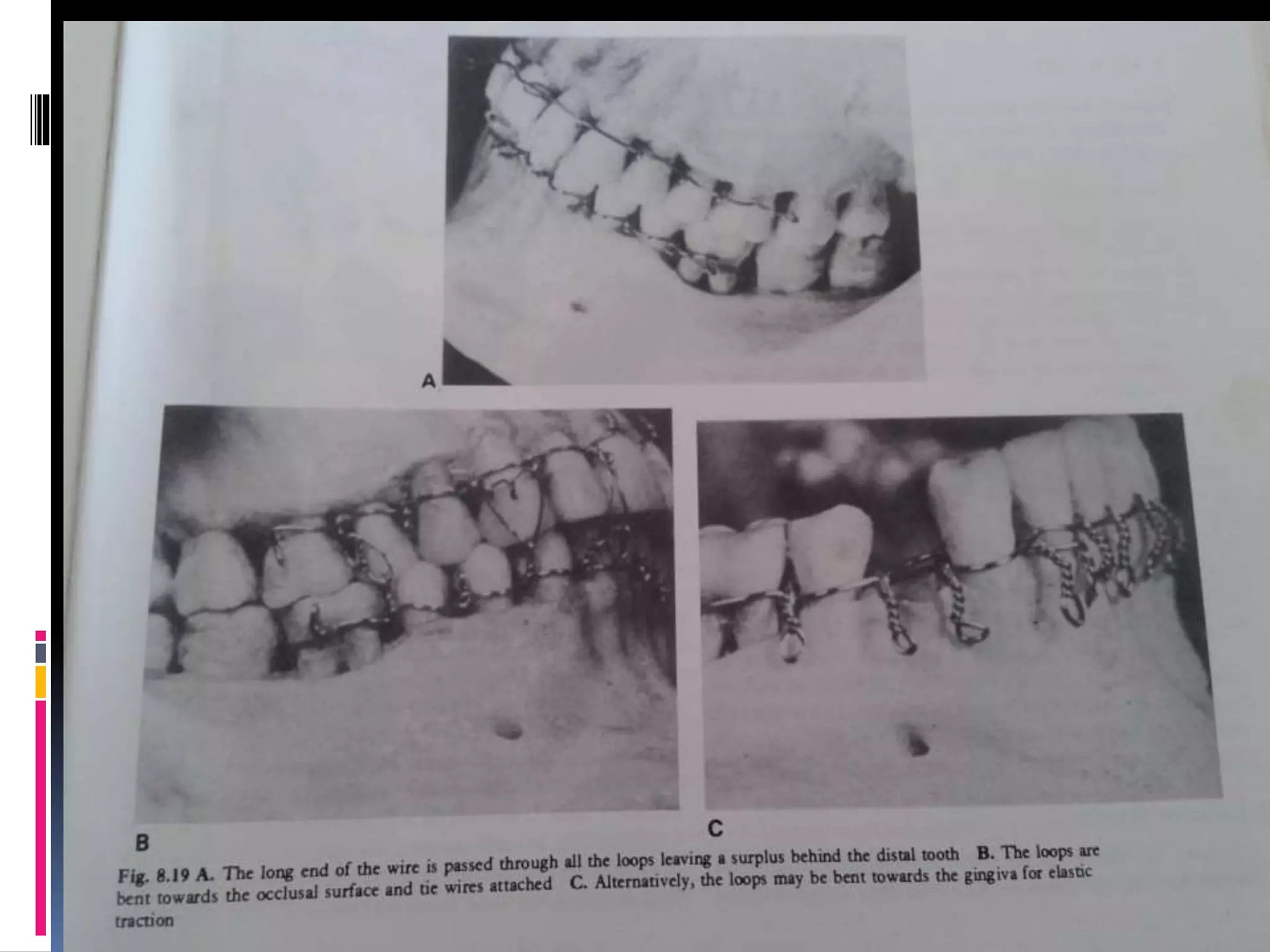 Various intermaxillary fixation techniques | PPTX