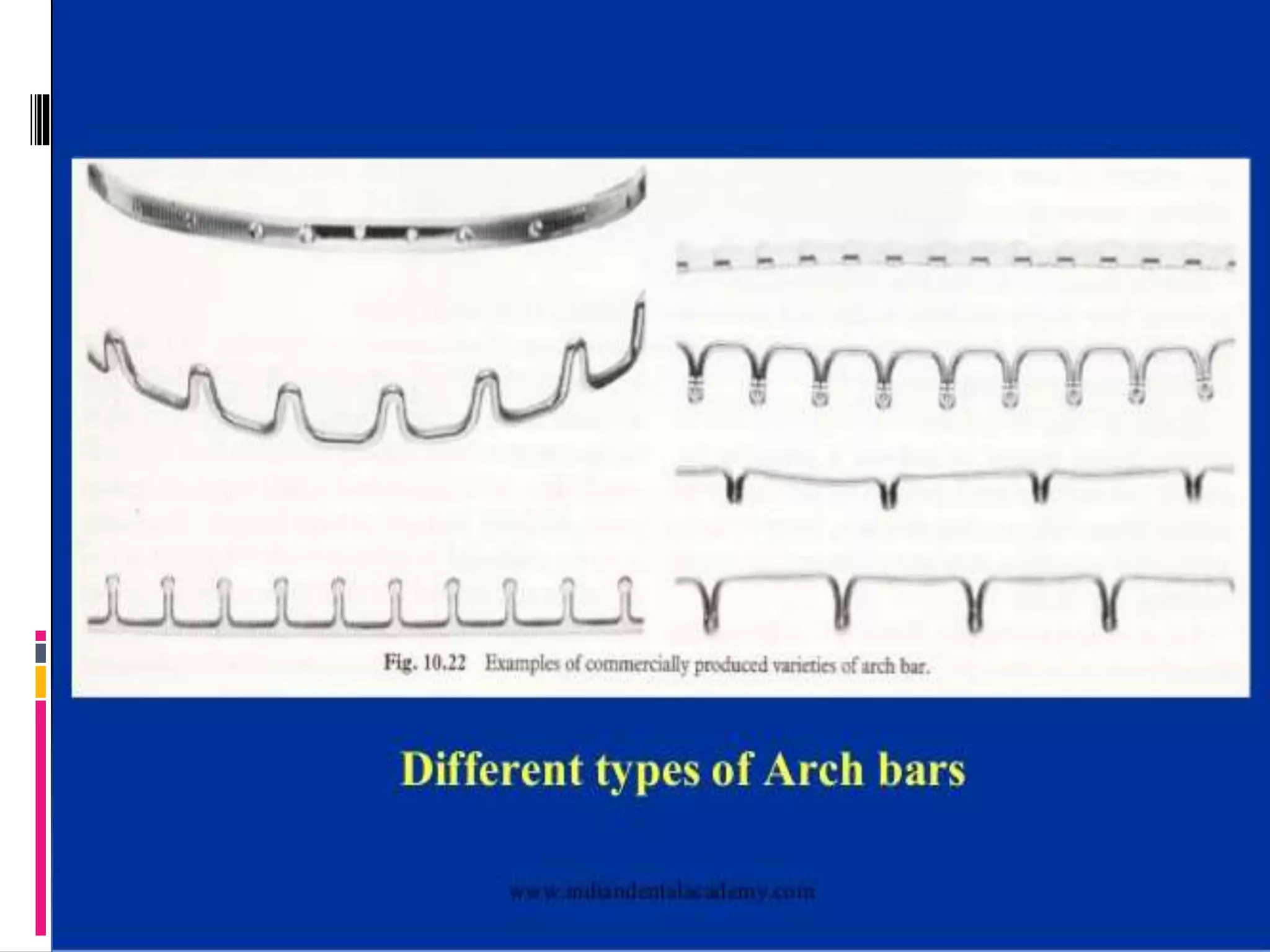 Various intermaxillary fixation techniques | PPTX