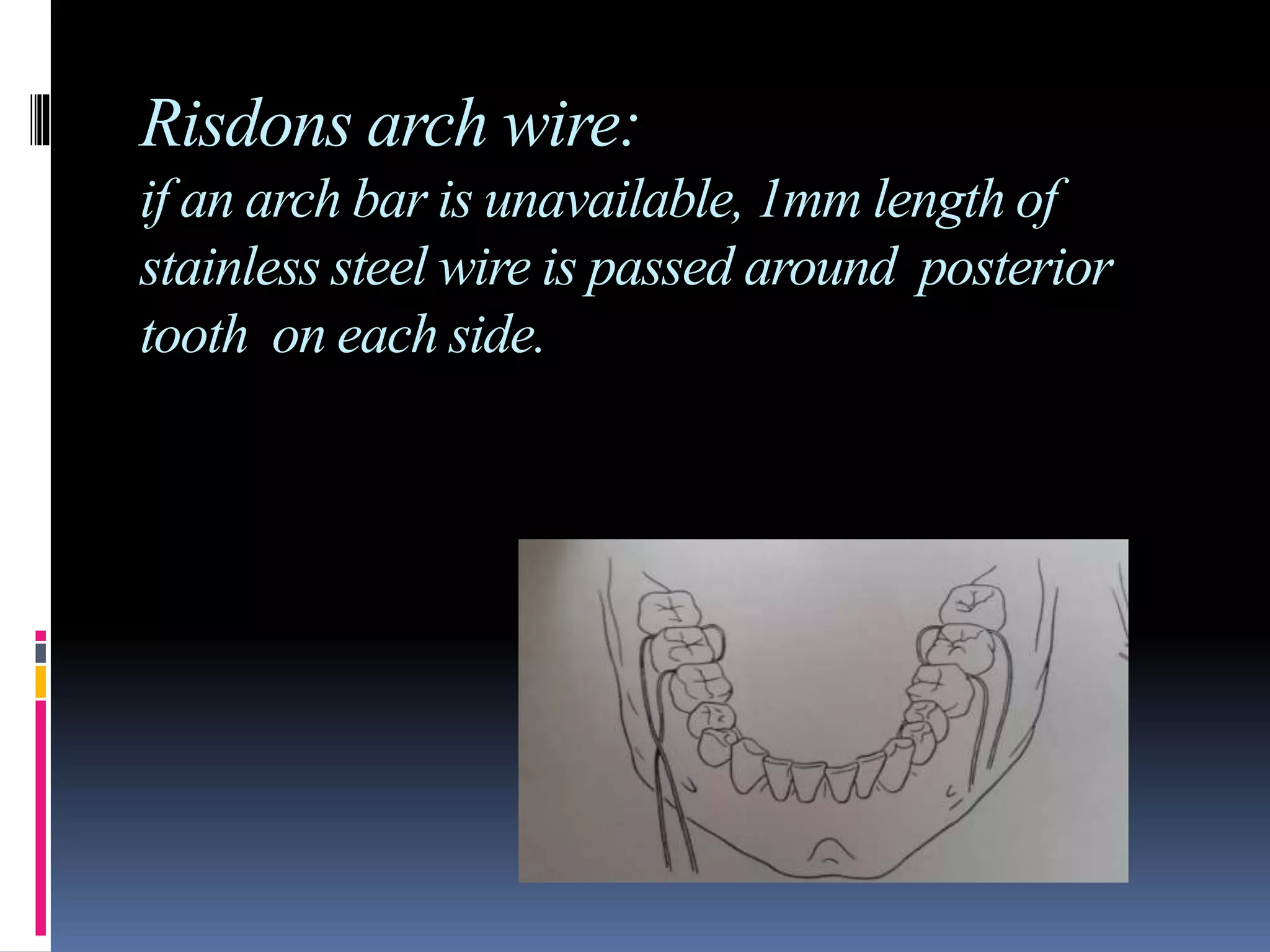 Various intermaxillary fixation techniques | PPTX