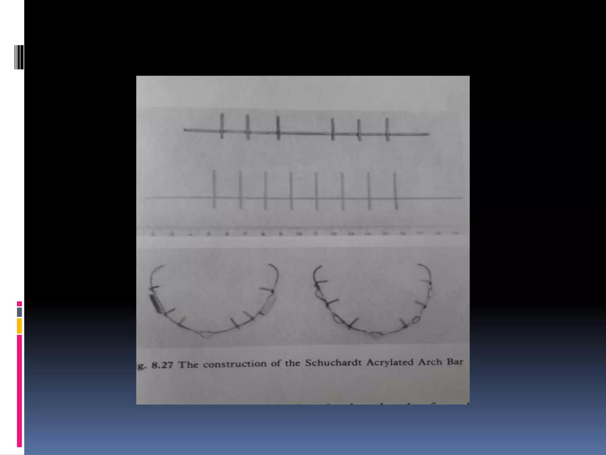 Various intermaxillary fixation techniques | PPTX