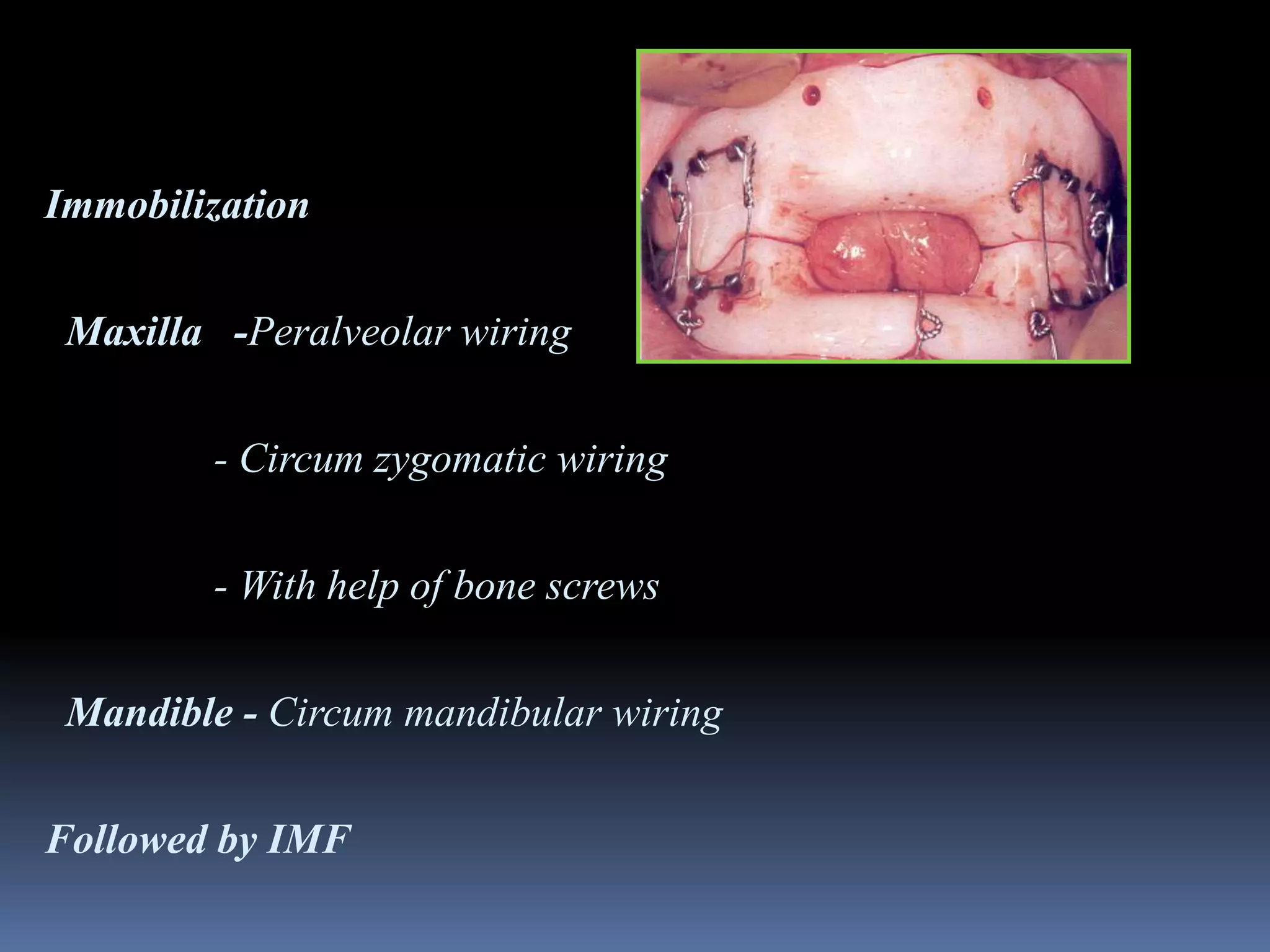 Various intermaxillary fixation techniques | PPTX
