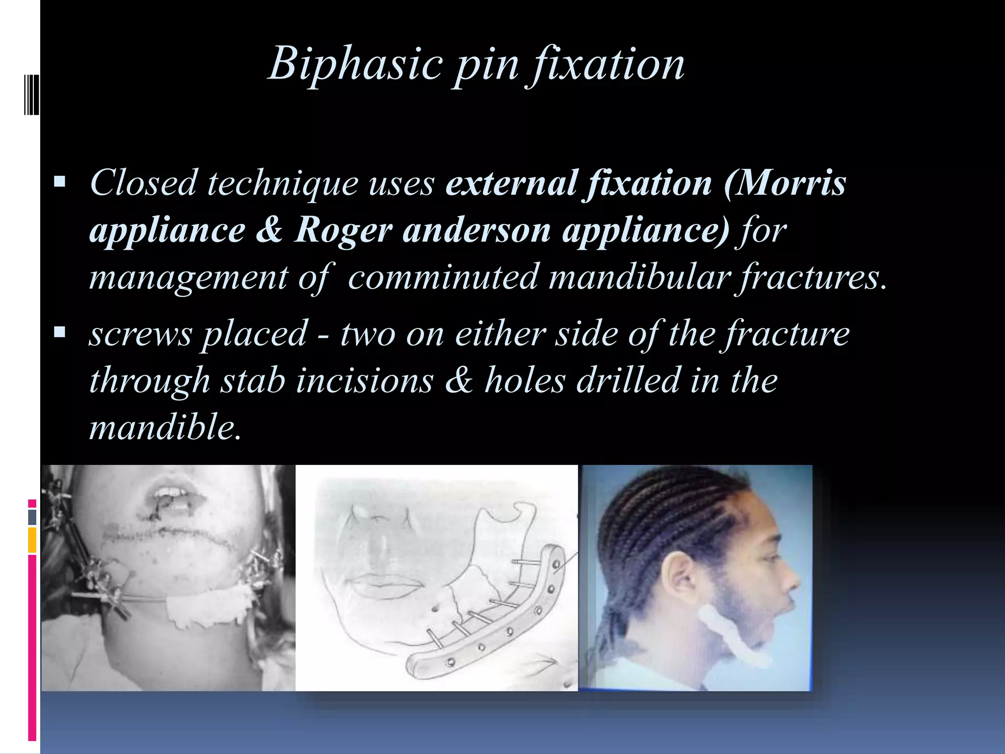 Various intermaxillary fixation techniques | PPTX
