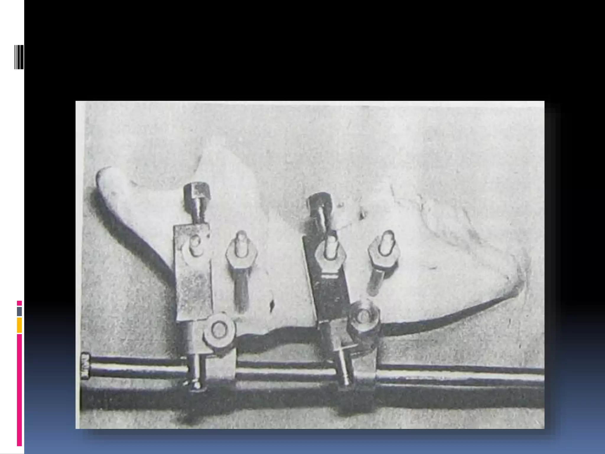 Various intermaxillary fixation techniques | PPTX