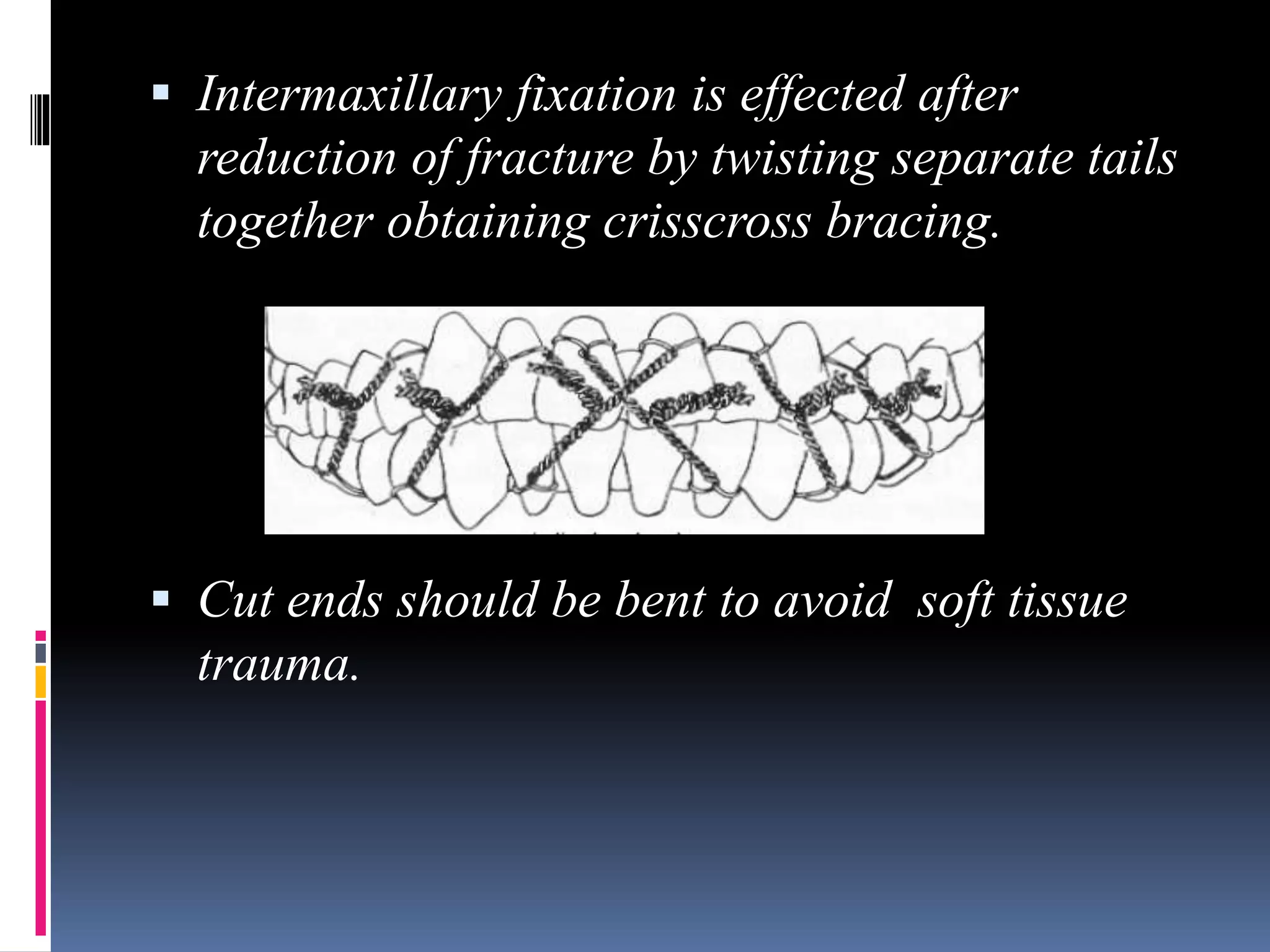 Various intermaxillary fixation techniques | PPTX