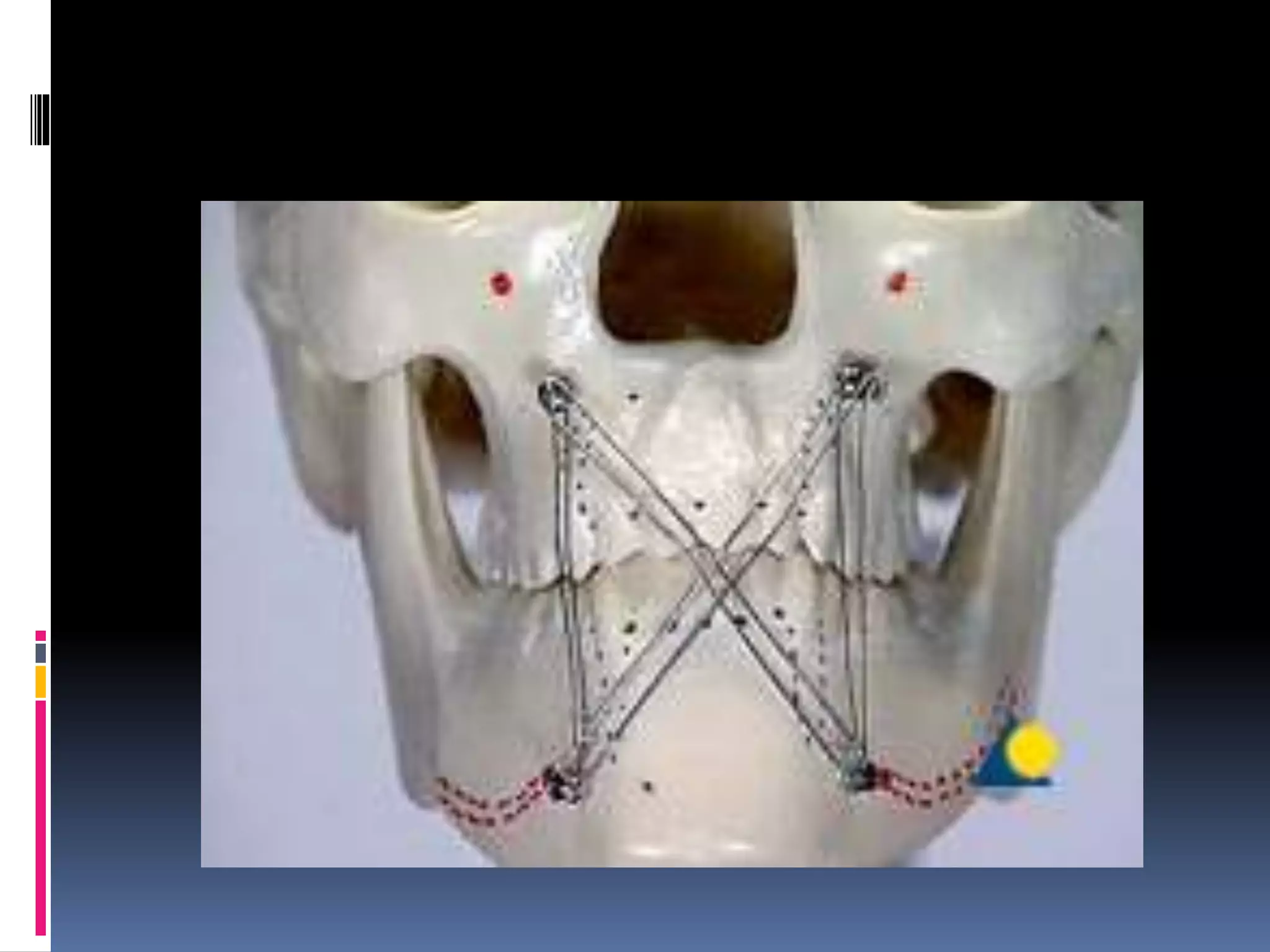 Various intermaxillary fixation techniques | PPTX