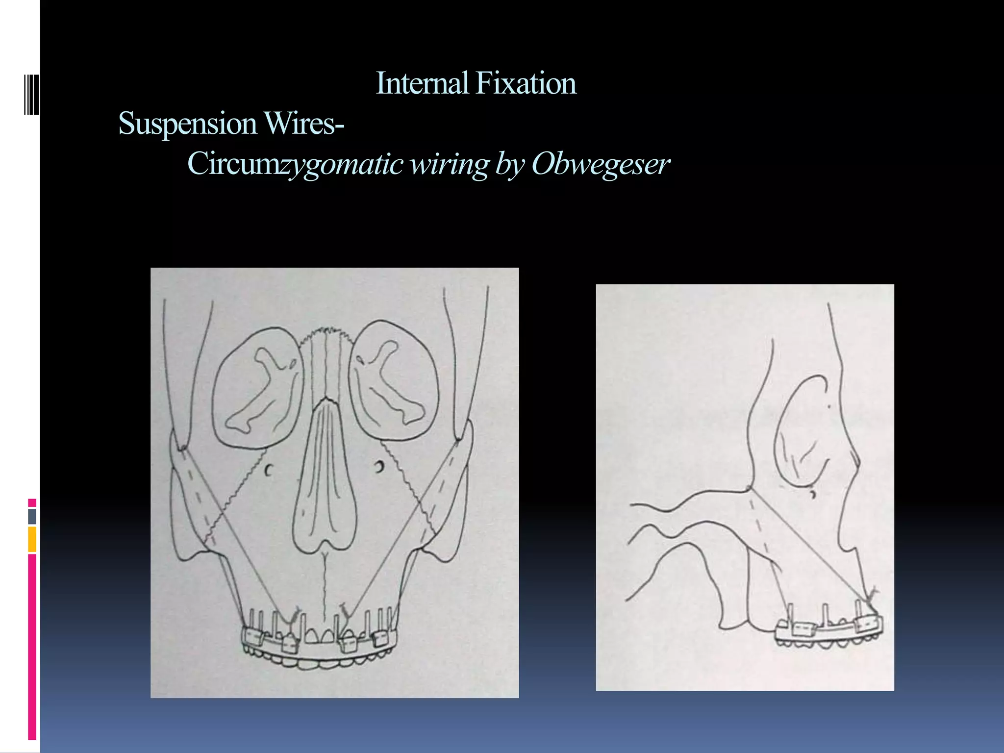 Various intermaxillary fixation techniques | PPTX