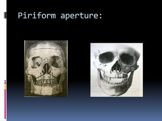 Various intermaxillary fixation techniques | PPTX
