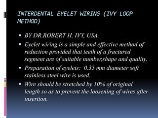 Various intermaxillary fixation techniques | PPTX