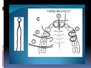 Various intermaxillary fixation techniques | PPTX