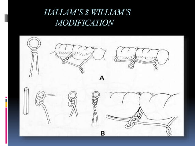 Various intermaxillary fixation techniques | PPTX