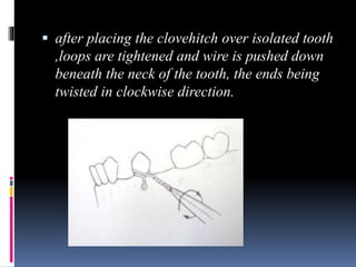 Various intermaxillary fixation techniques | PPTX