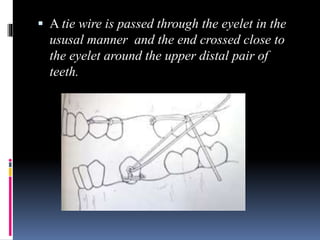 Various intermaxillary fixation techniques | PPTX