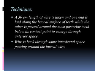 Various intermaxillary fixation techniques | PPTX
