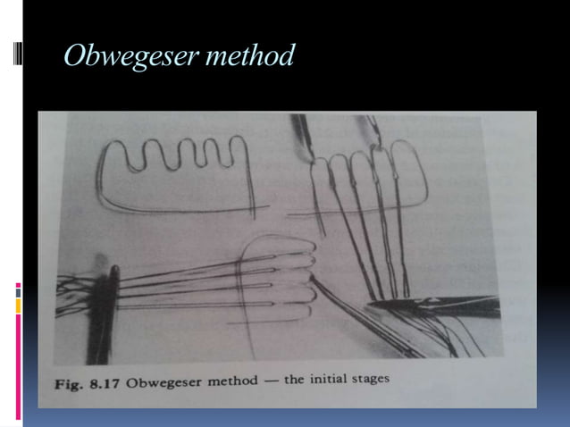 Various intermaxillary fixation techniques | PPTX