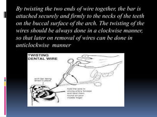 Various intermaxillary fixation techniques | PPTX