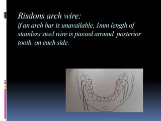 Various intermaxillary fixation techniques | PPTX