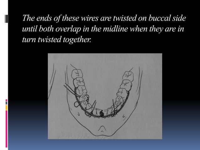 Various intermaxillary fixation techniques | PPTX