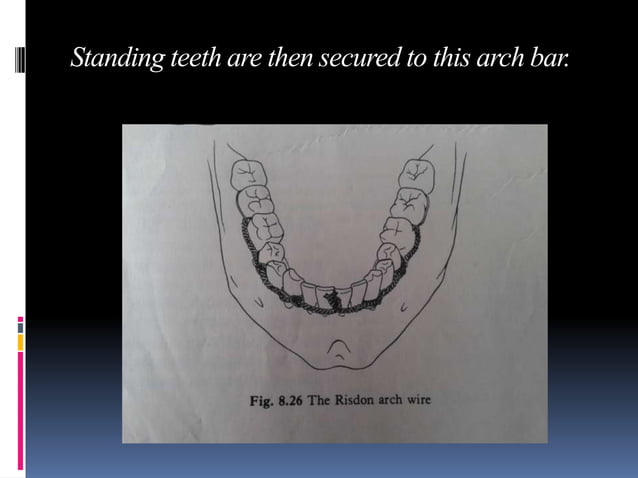 Various intermaxillary fixation techniques | PPTX