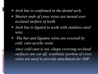 Various intermaxillary fixation techniques | PPTX